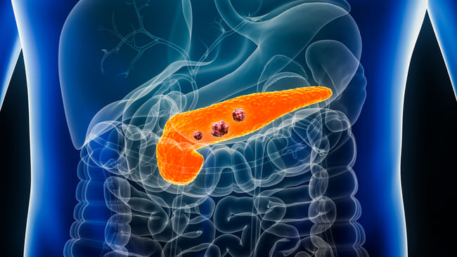Transplant de pancreas în Turcia: Prețuri și ghid complet